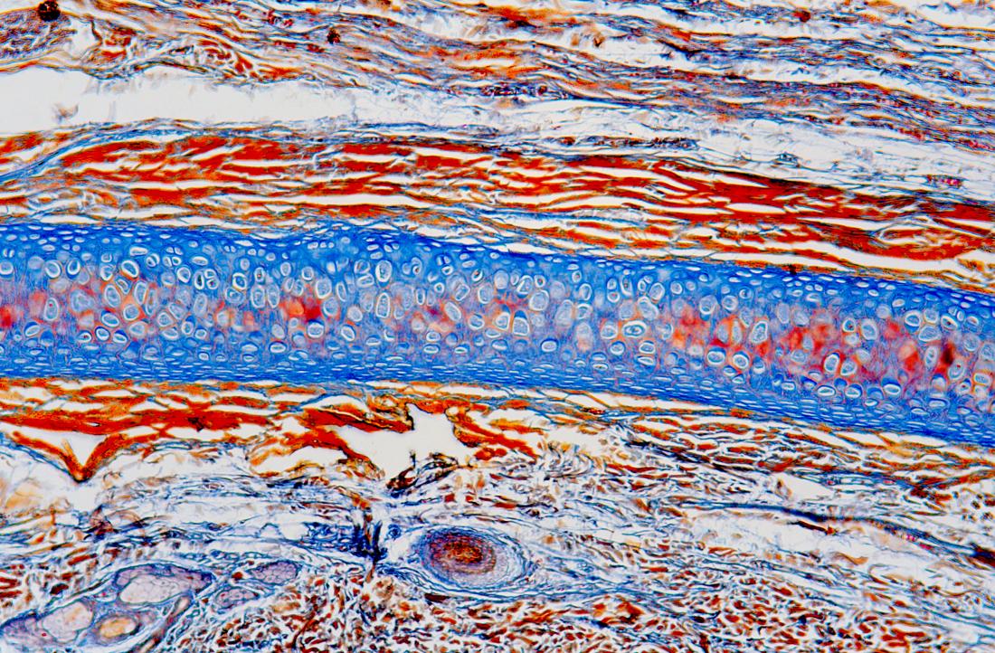 Cartilage damage: Symptoms, causes, diagnosis, and treatment