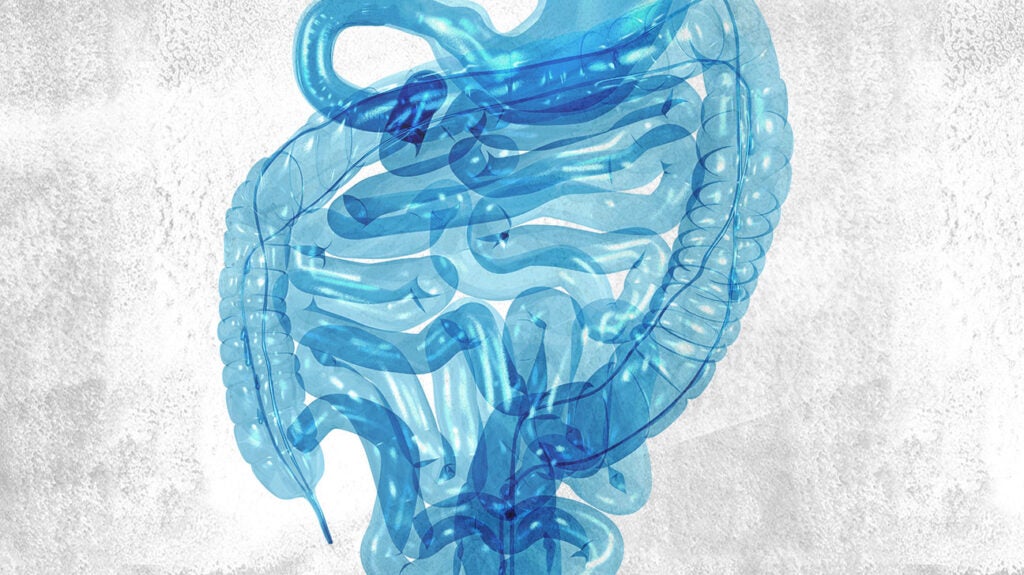 Stages of Crohn's disease: Symptoms, complications, and treatment