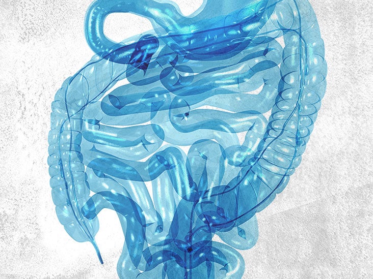 Stages Of Crohns Disease Symptoms Complications And Treatment