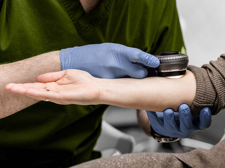 Skin Cancer Moles On Hand
