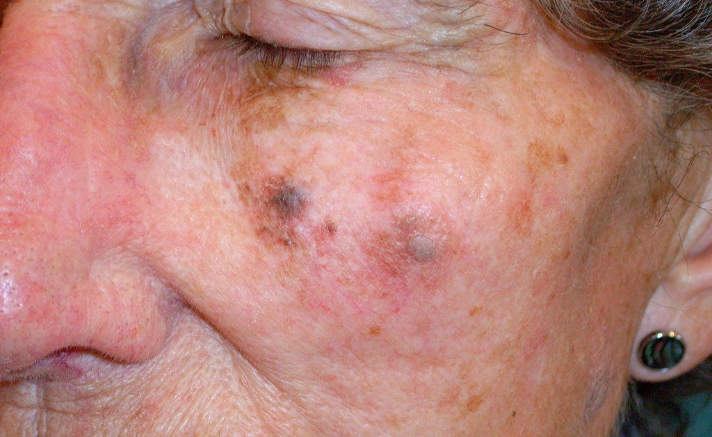 Lentigo Maligna Melanoma Pictures Symptoms And Outlook Lentigo Maligna Melanoma Pictures Symptoms And Outlook