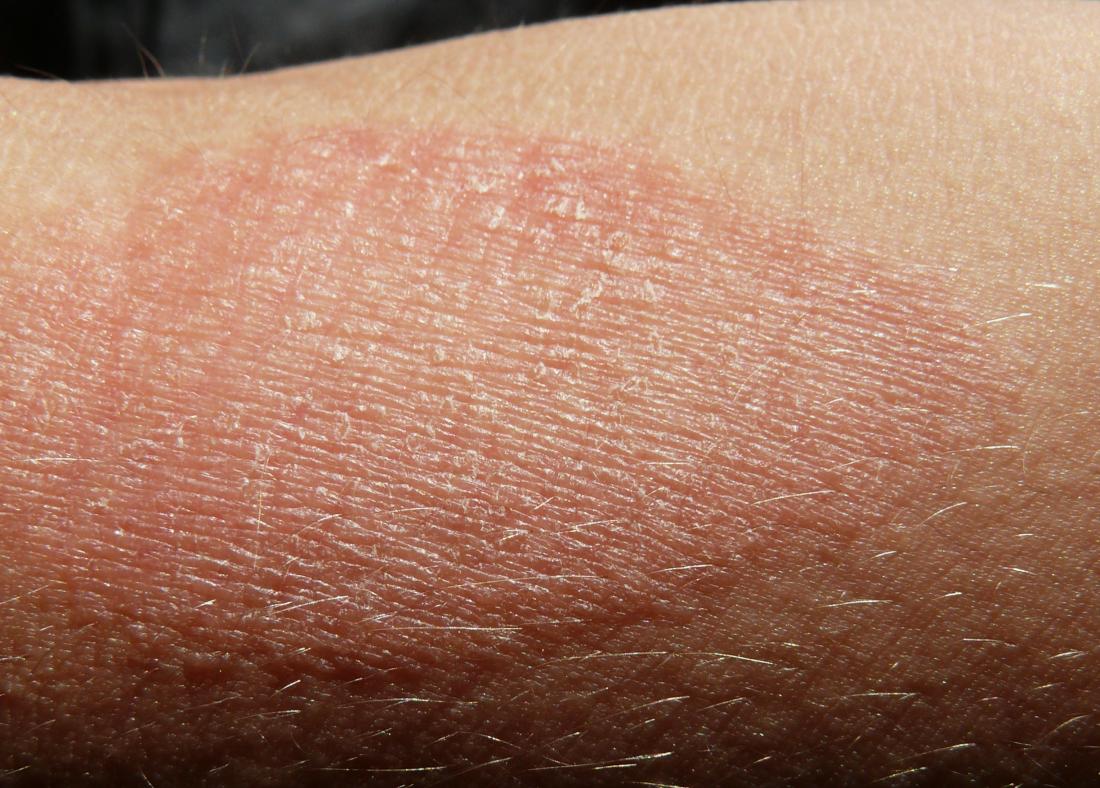 Dry Skin Patches Causes Symptoms Diagnosis And Treatments Dry Skin Patches Causes Symptoms Diagnosis And Treatments