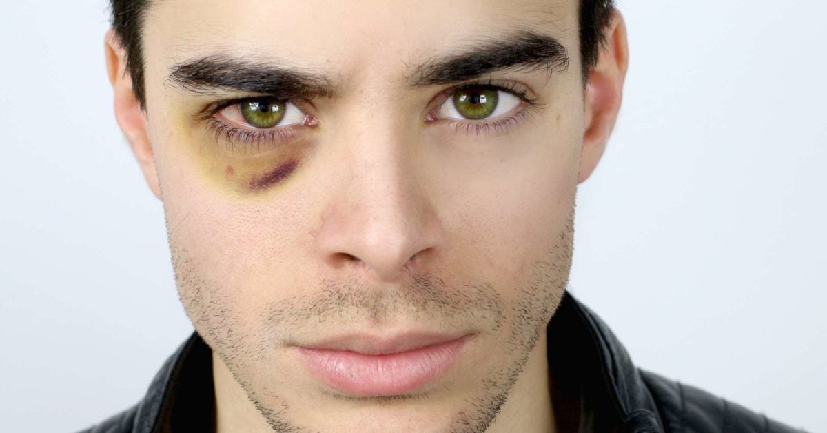 Black Eye Causes Effects Treatment And Prevention