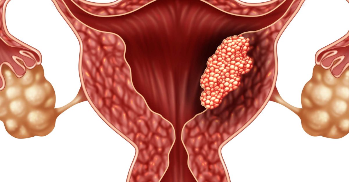 Endometrial Cancer Symptoms Staging Treatment And Causes