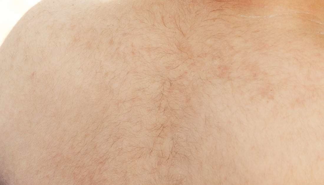 Lanugo Causes Function And Treatment