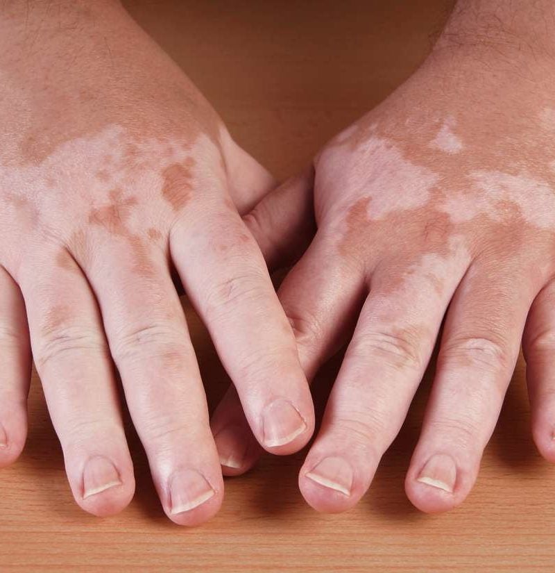 Hypopigmentation: Causes, types, and treatment