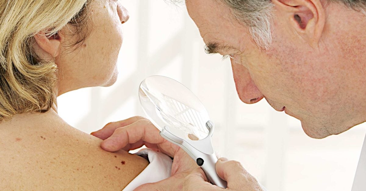 Bleeding mole: Causes and what to do