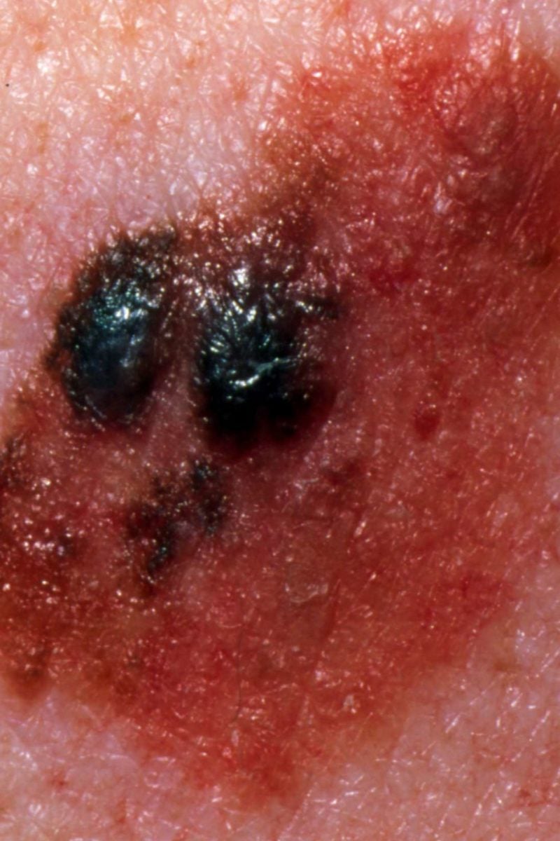 Stage 4 Melanoma Survival Rate Pictures And Treatment Stage 4 Melanoma Survival Rate Pictures And Treatment