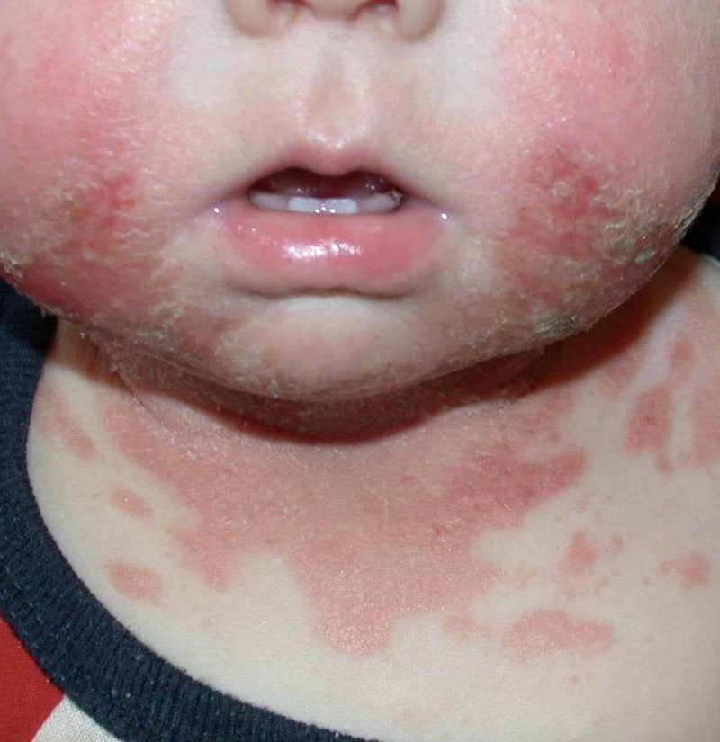 Drool Rash Treatment Prevention And When To See A Doctor Drool Rash Treatment Prevention And When To See A Doctor