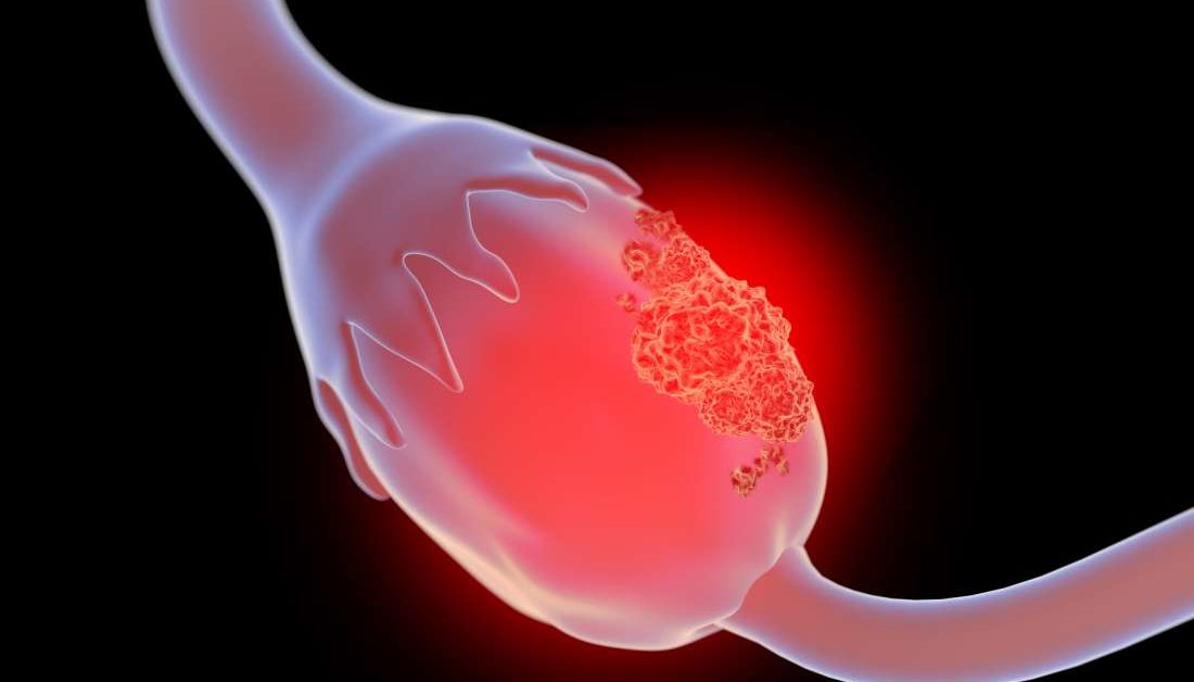 Ovarian cancer: Scientists find a way to launch dual attack