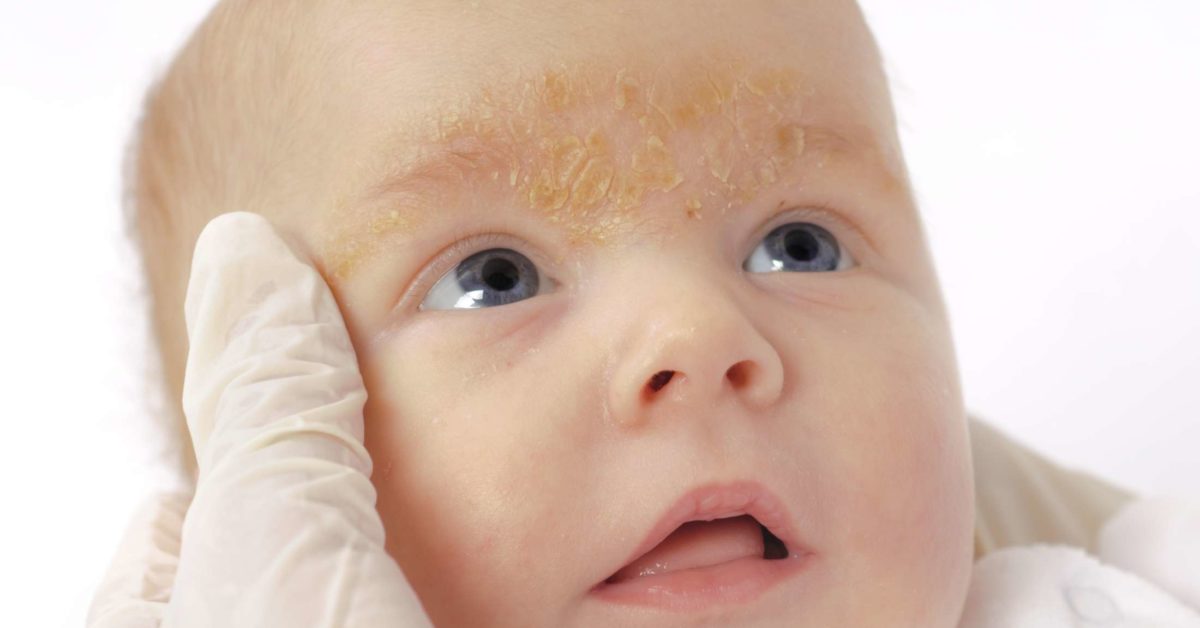 Rash On A Baby s Face Pictures Causes And Treatments Rash On A Baby s Face Pictures Causes And Treatments