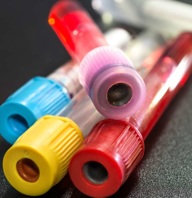 Rheumatoid Arthritis And CRP Levels What Is Normal Rheumatoid Arthritis And CRP Levels What Is Normal