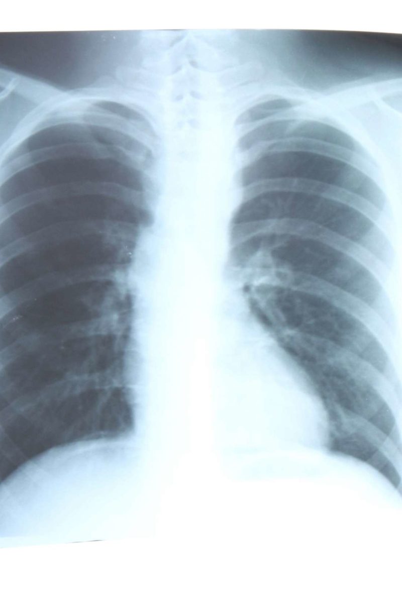 Tuberculosis: Causas, síntomas y tratamientos