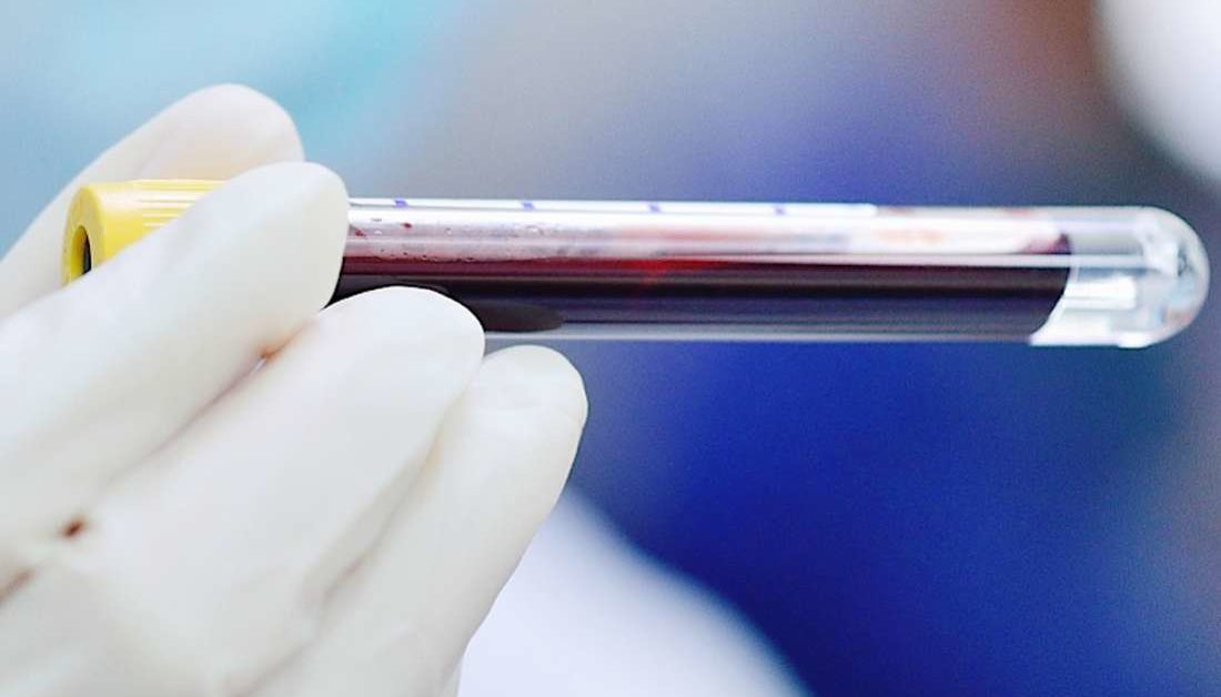 Luteinizing Hormone LH Test Uses Ranges And Results