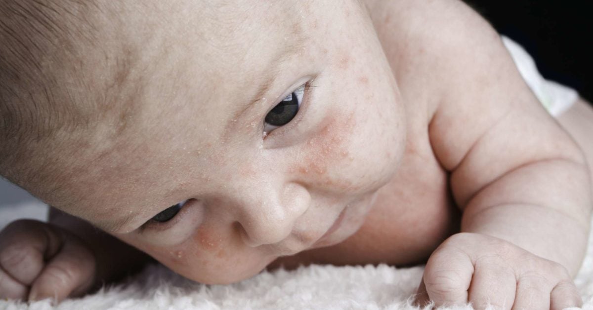 Dry Skin On A Baby s Face Causes And Remedies Dry Skin On A Baby s Face Causes And Remedies