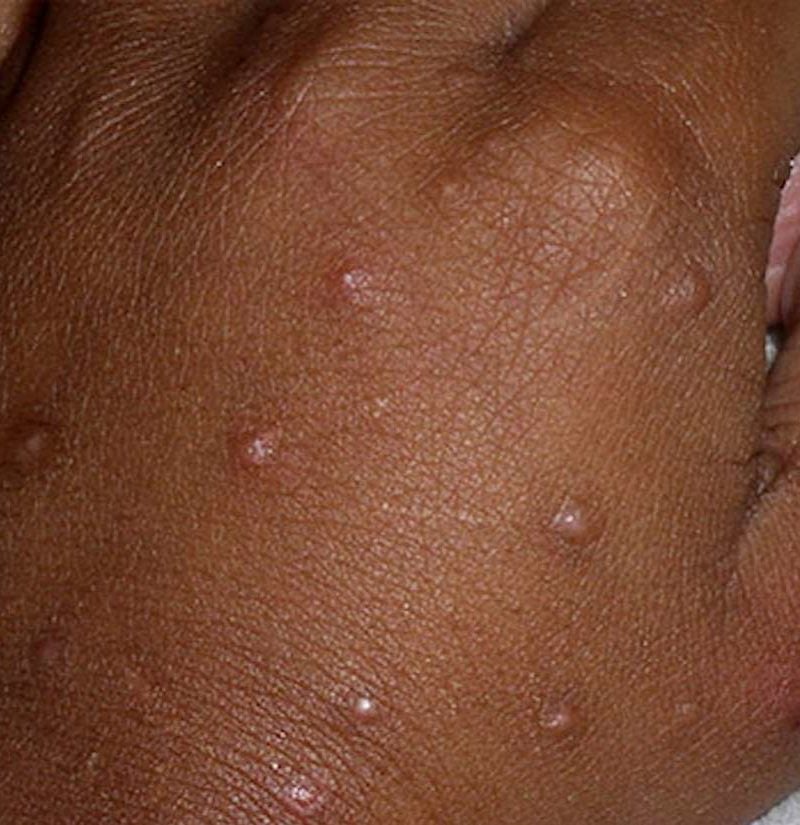 Acropustulosis In Infants Symptoms Causes And Treatment