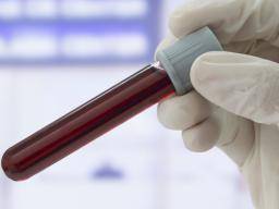 Hyperchloremia (high chloride): Symptoms, causes, and treatments