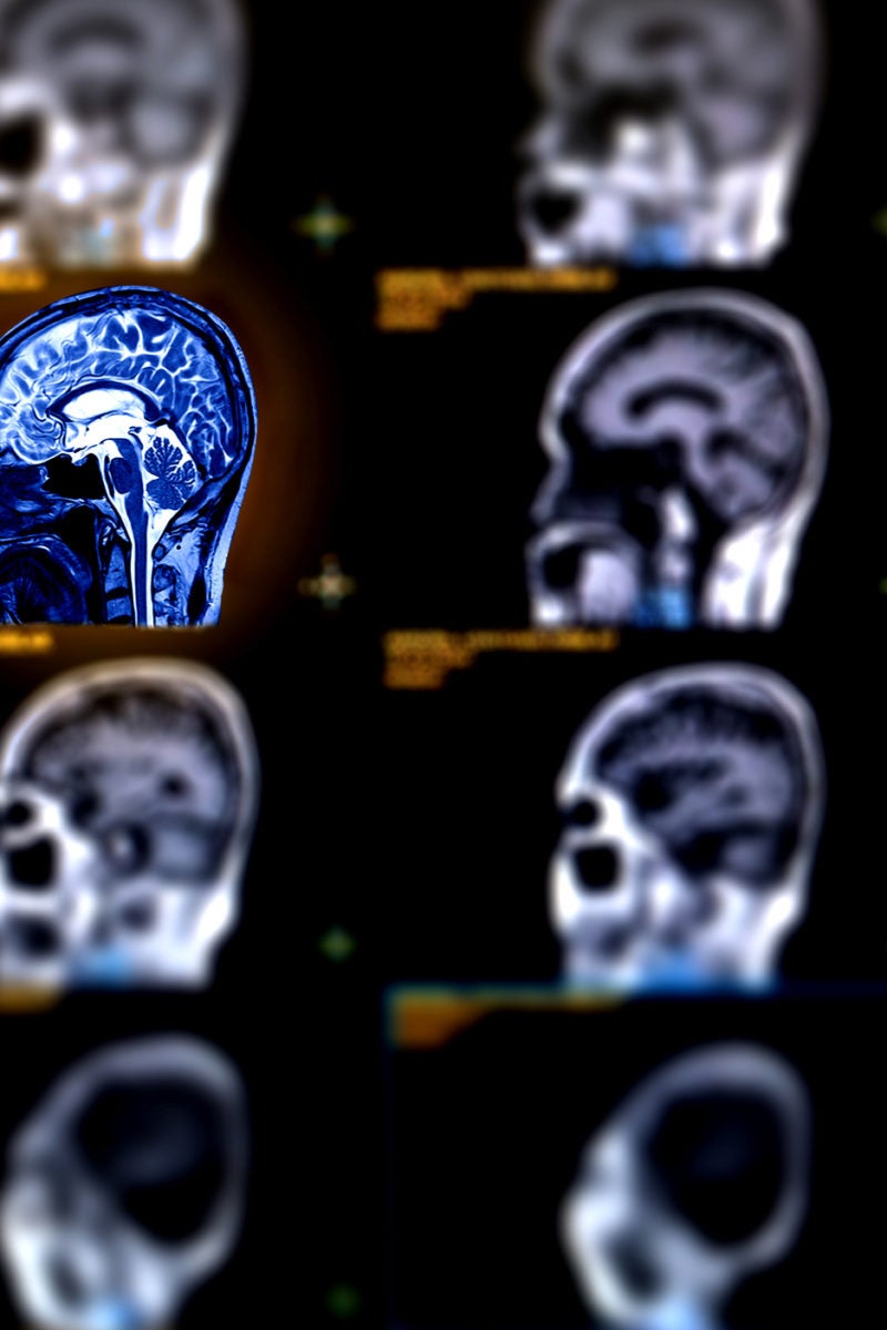 Antisocial Personality Disorder Brain