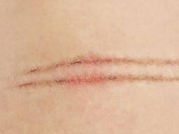 Koebner phenomenon in psoriasis: Causes, treatment, prevention
