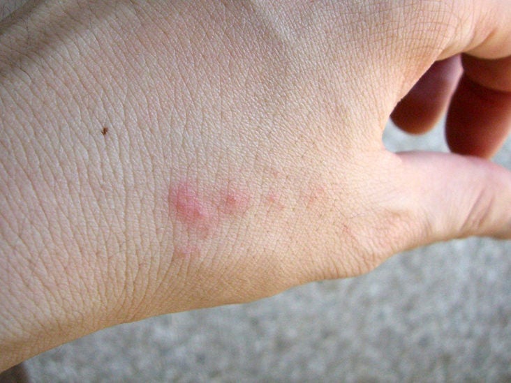 Big Red Itchy Bumps On My Body BEST GAMES WALKTHROUGH
