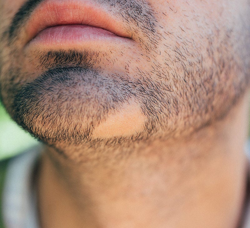 Bald Patch In Beard Causes And Treatments Bald Patch In Beard Causes And Treatments