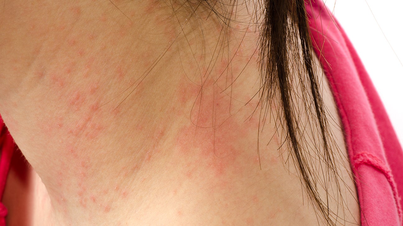 Mite Bites Mite Bites