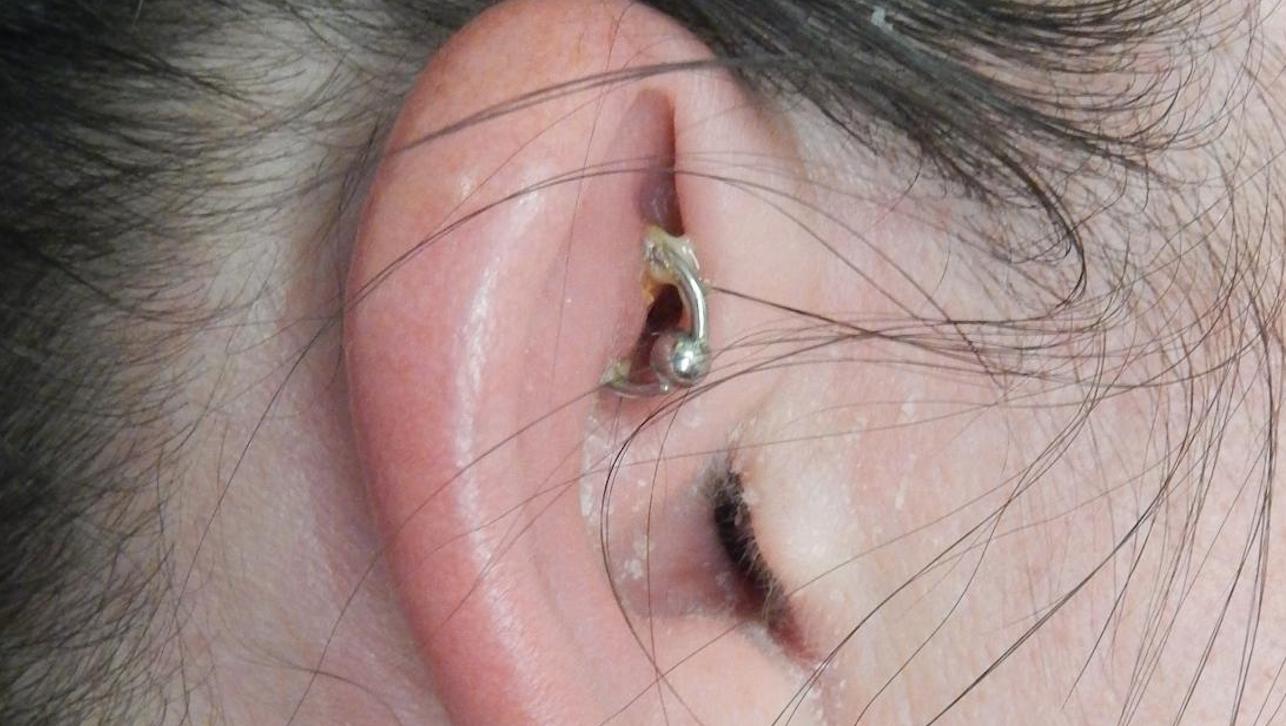 Medical Complications Of Cartilage And Ear Piercing ChildrensMD