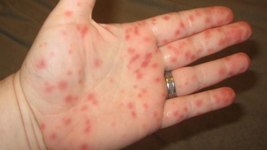 Sore Throat And Rash Strep Infection And Other Causes