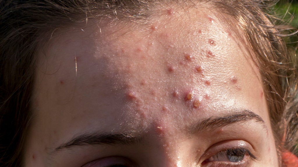 Acne Cyst Forehead
