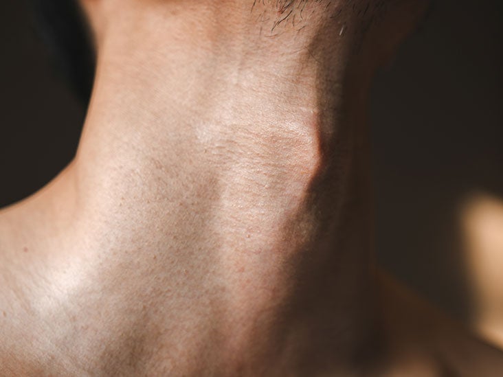 T3 levels: What is normal and what the test results mean