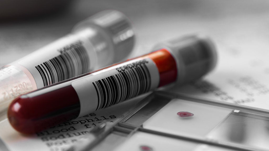 Addison's disease: Diagnosis