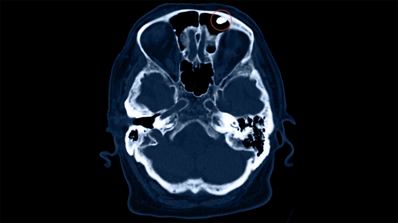 Osteoid Osteoma Orthoinfo Aaos