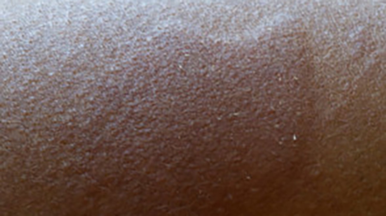 Urticaria No Pescoco Pele Negra Urticaria No Pescoco Pele Negra