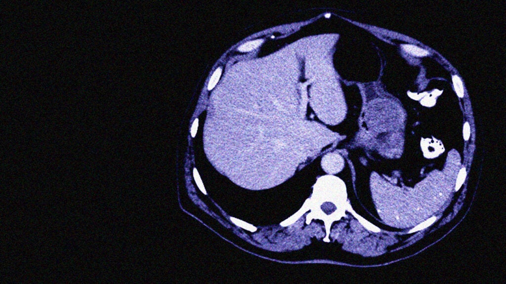 Gastrointestinal stromal tumor (GIST): Symptoms, treatment, outlook