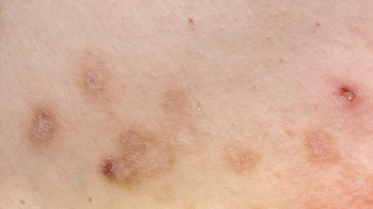 Dermatitis During Pregnancy Dermatitis During Pregnancy
