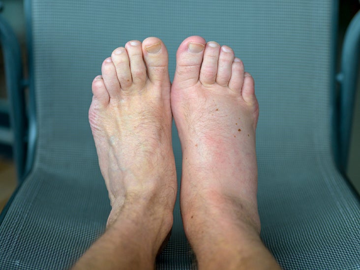 HAE attacks: Frequency, triggers, and more