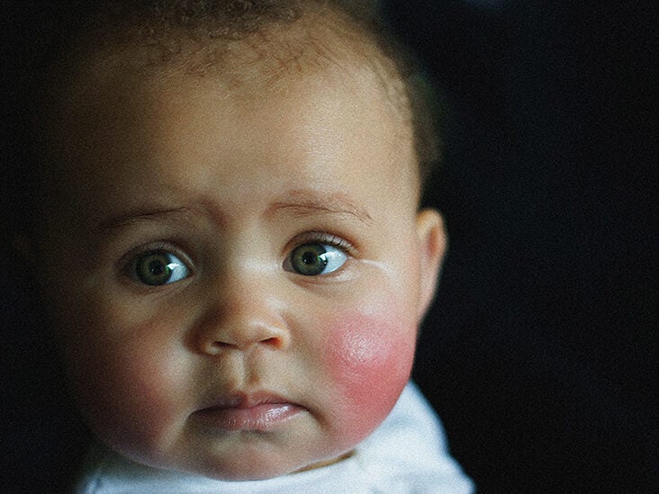 Irritated Baby Look