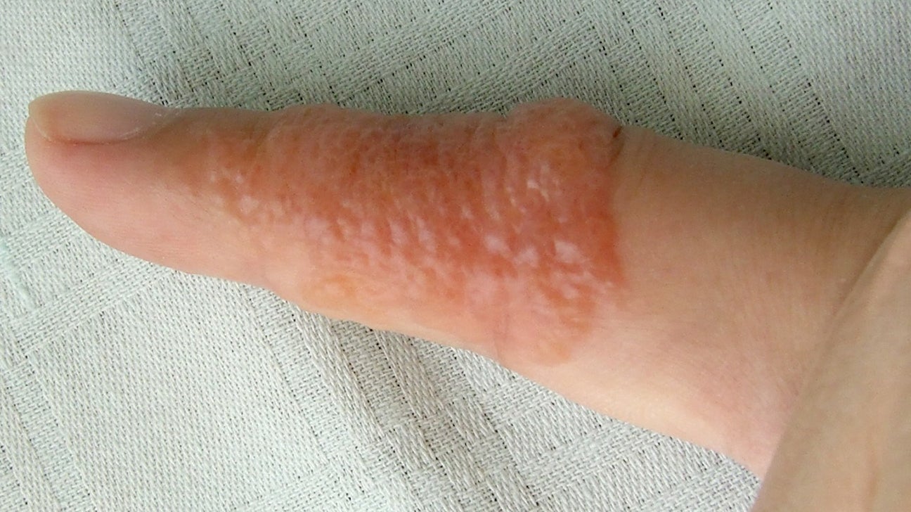 Itchy Pus Filled Bump On Foot Sale Online Emergencydentistry Itchy Pus Filled Bump On Foot Sale Online Emergencydentistry