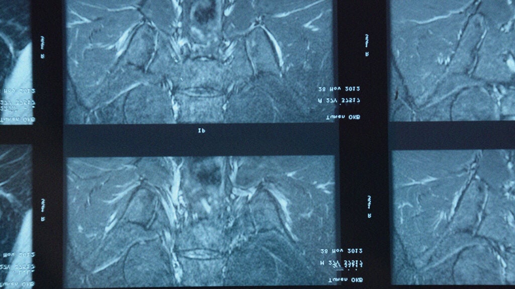 Ankylosing spondylitis: Tests, diagnosis, and treatment