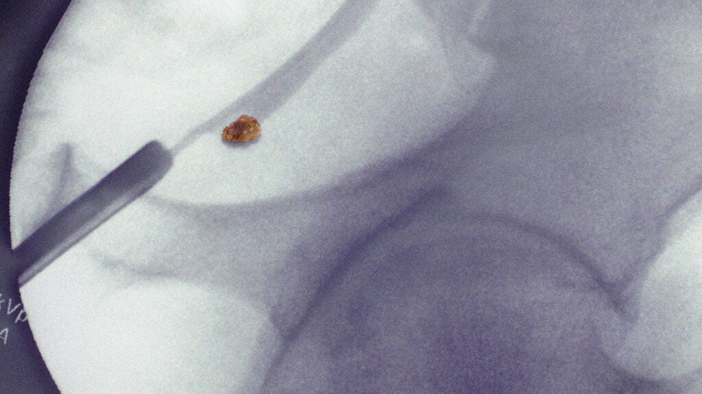 Kidney stones: Causes, symptoms, and treatment