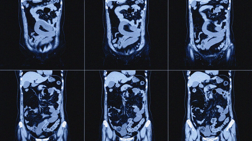 How long are your intestines? Length of small and large intestine