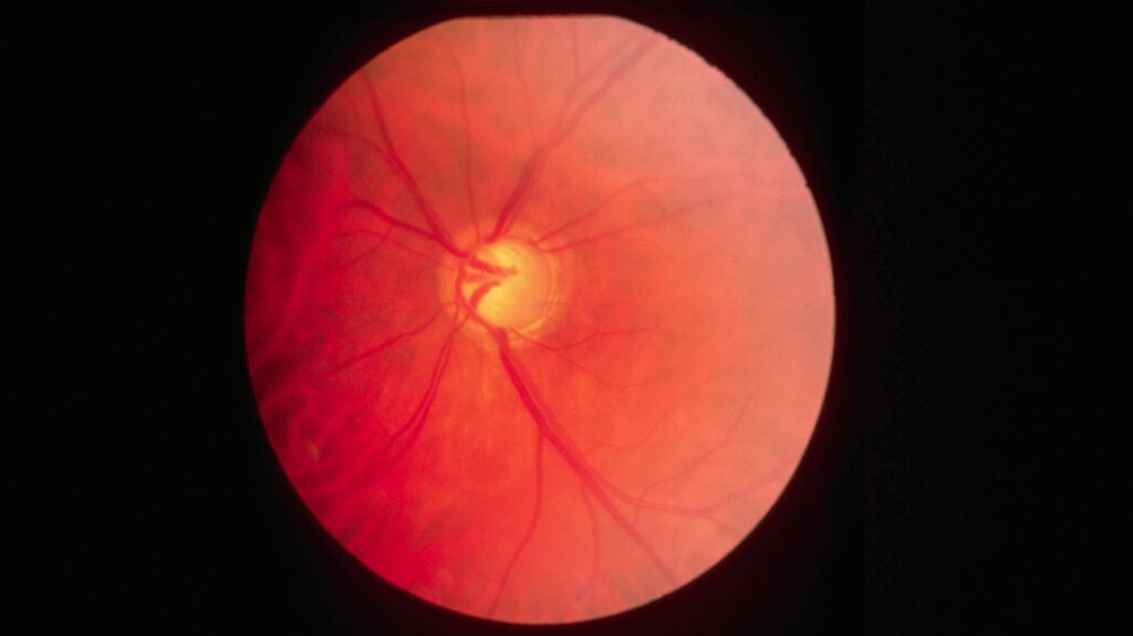 Glaucoma: Types, causes, and symptoms