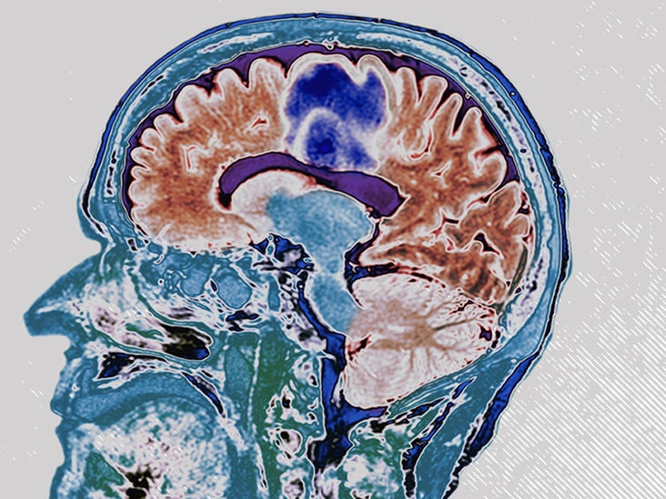 Existing drugs may cut off 'fuel supply' to an aggressive brain cancer