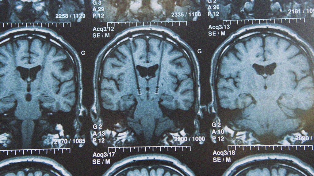 Personalized Brain Stimulation Lifts A Patients Depression