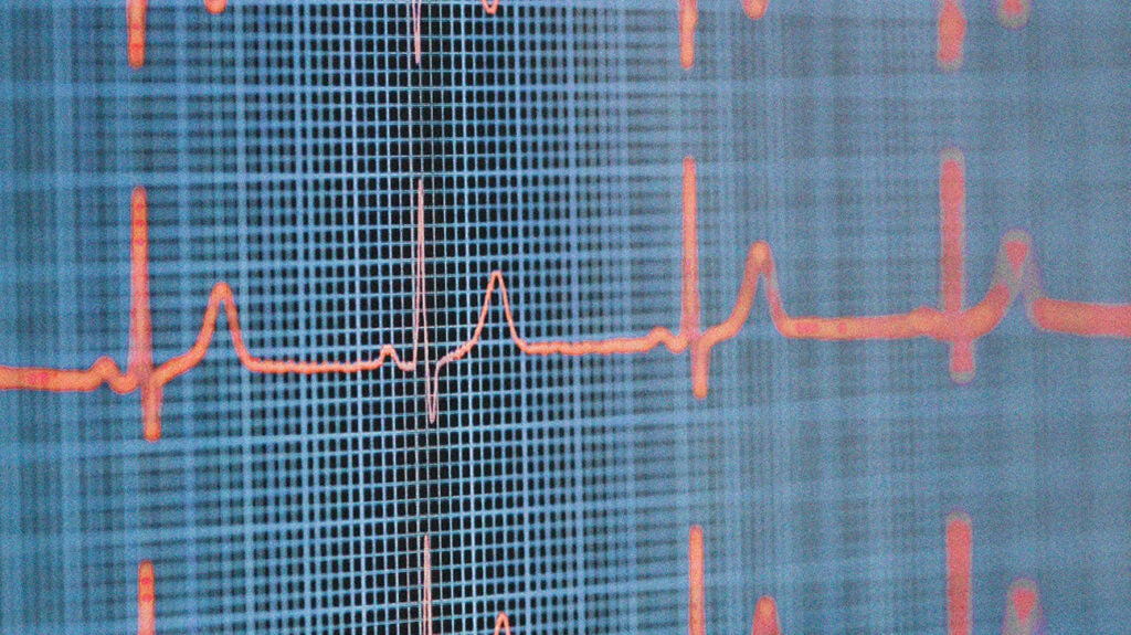 Acute heart failure: Types, symptoms, treatment, and causes