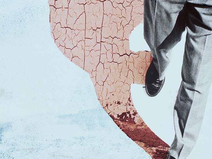 High cholesterol: Symptoms, causes, and treatments