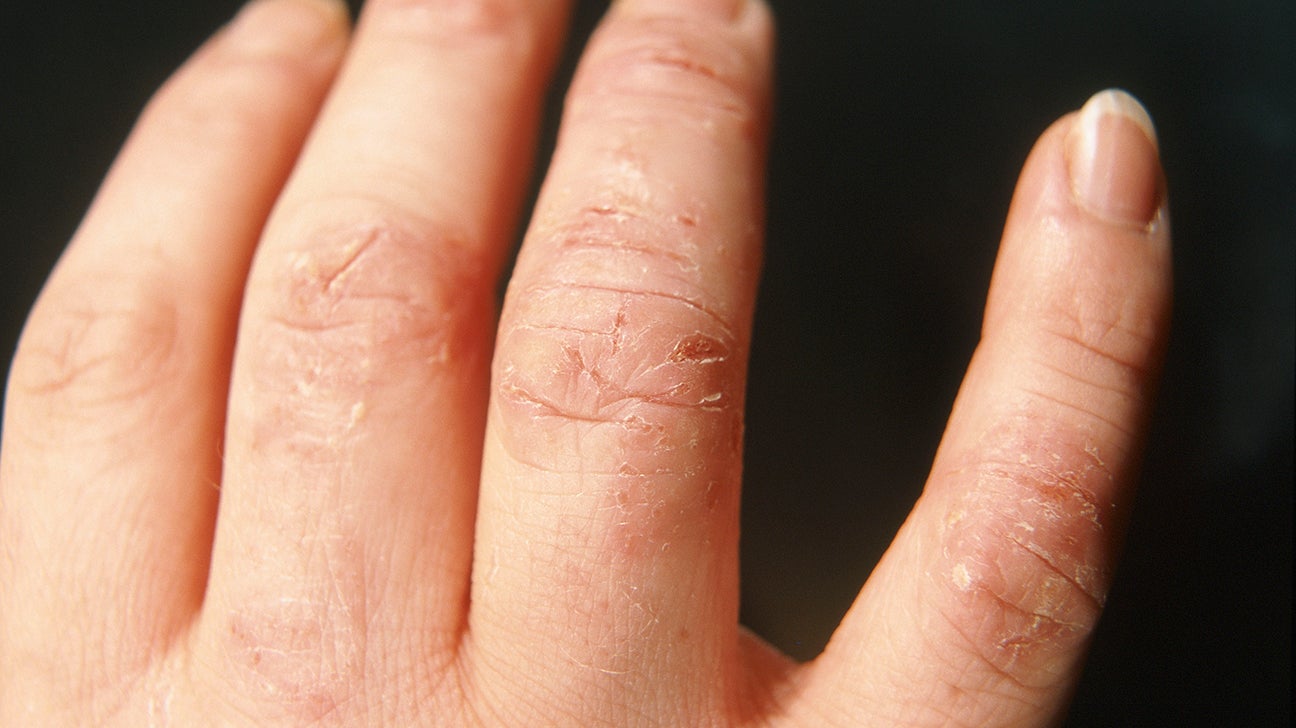 Eczema On Knuckles Hand Eczema Hand Dermatitis
