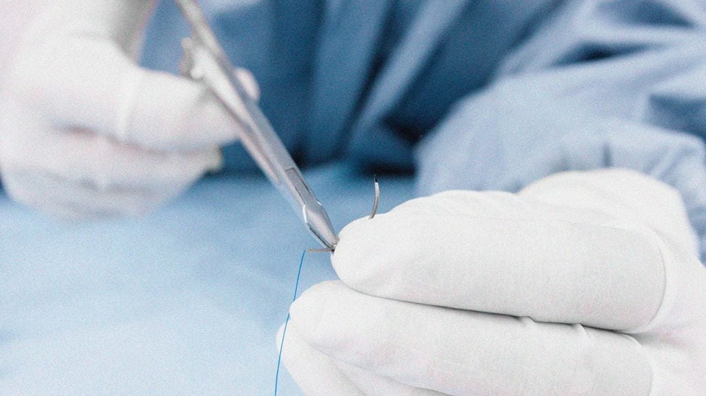 Tongue stitches: Aftercare, healing times, and when to seek help