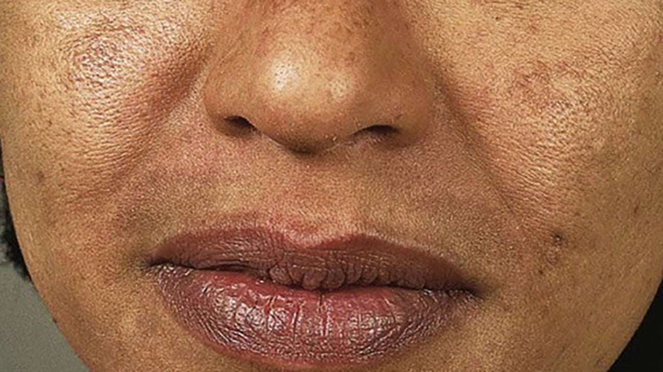 Melasma On Black Skin Causes Treatment And More 59 OFF Melasma On Black Skin Causes Treatment And More 59 OFF