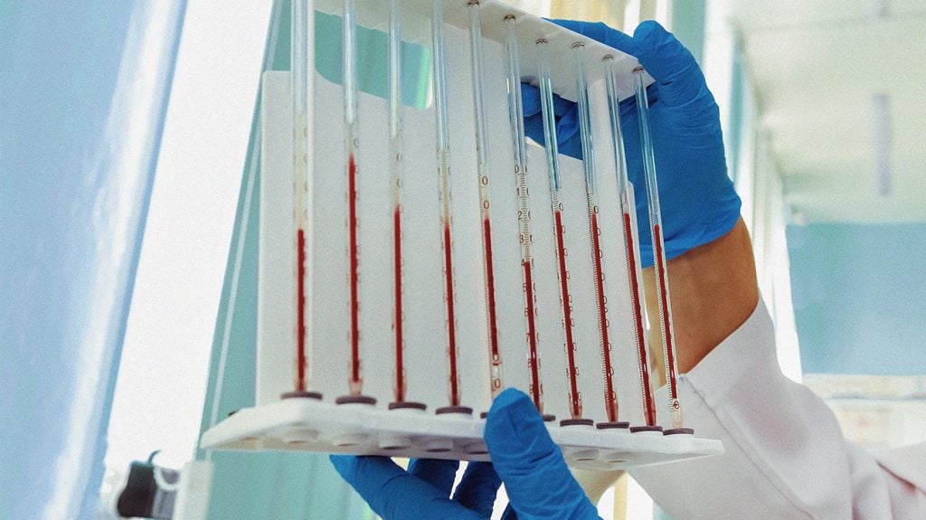 Multiple myeloma stages: Explanation, outlook, coping, and more